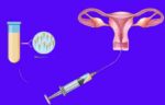 What is an iui ? What are the possibilities getting pregnant with IUI ...